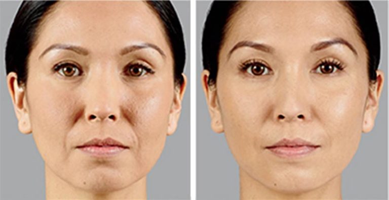 Voluma Facial Filler Long Island | Long Island Voluma Treatments