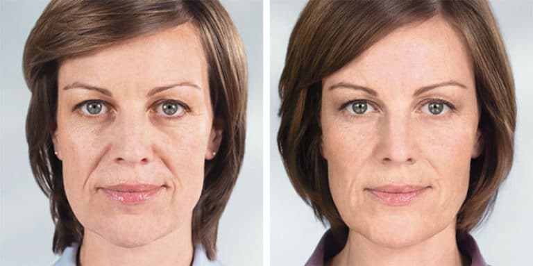 Sculptra Long Island | Long Island Sculptra Injections